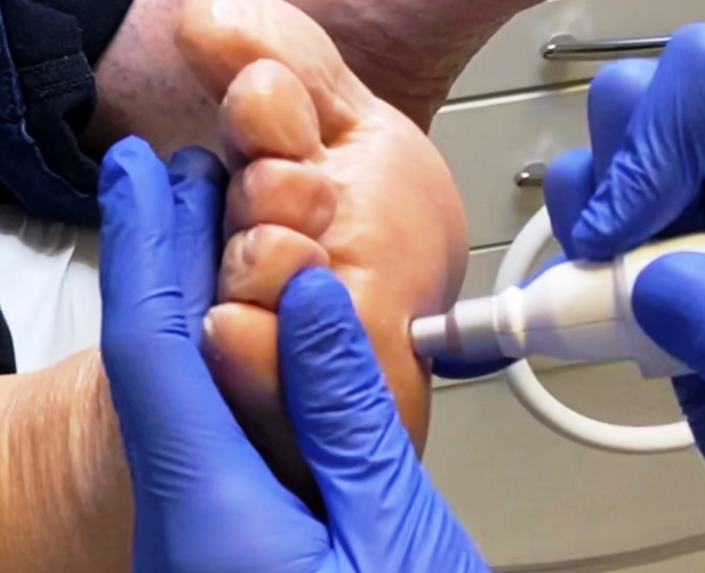 What is Swift Verruca Treatment? - One Step Ahead Podiatry
