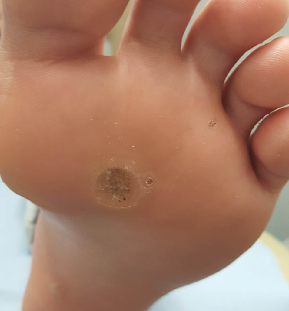 How to get rid of a verruca. - One Step Ahead Podiatry